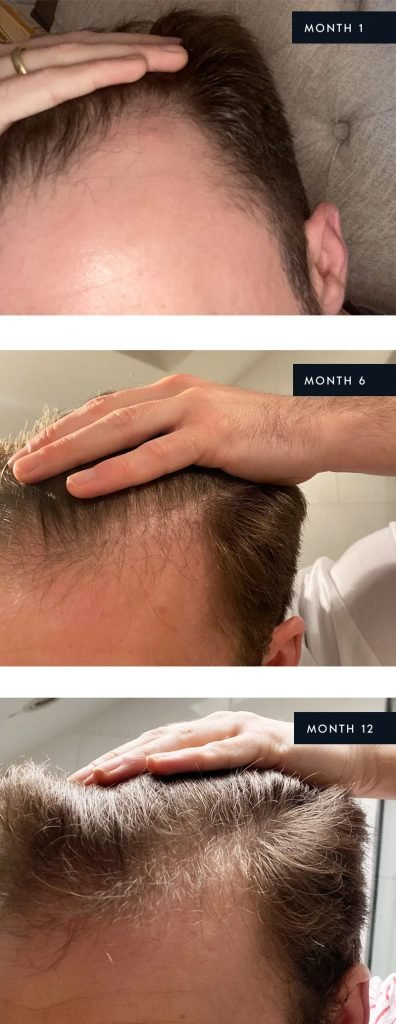 The Hair Follicle Neogenesis Growth Factors Serum - Hair Follicle ...